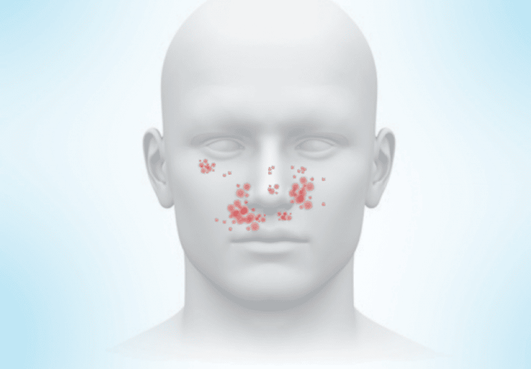 TSC/Facial Angiofibroma - HYFTOR® Patient Site