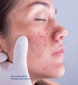 About HYFTOR - HYFTOR® Patient Site