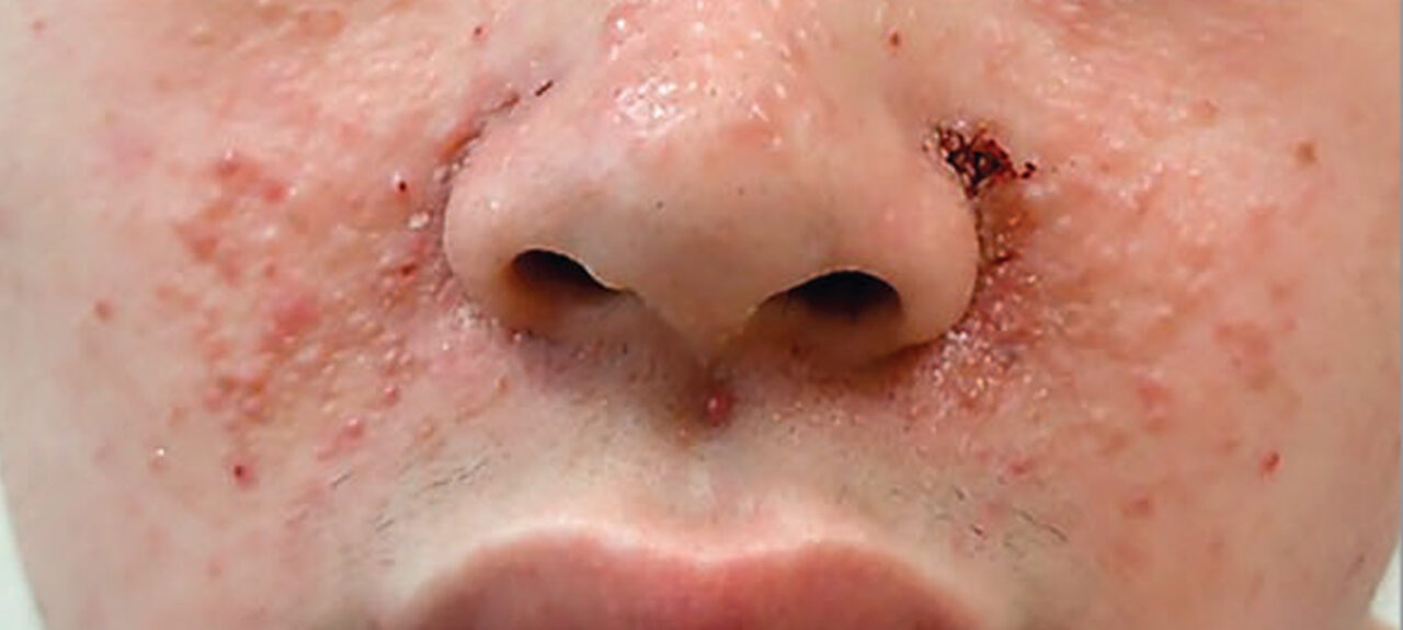 HYFTOR (Sirolimus Topical Gel) uses, benefits, safety - HYFTOR