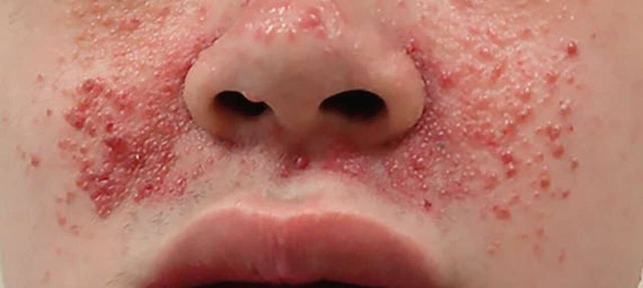 HYFTOR (Sirolimus Topical Gel) uses, benefits, safety - HYFTOR